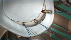 Lesão de Bankart: o que é, causas, diagnóstico e tratamento