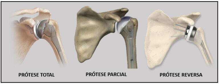 Prótese do Ombro (Artroplastia): reabilitação, resultado