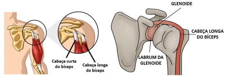 Tendinite do Bíceps - Medicina de Excelência - Ortopedista