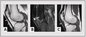 Tendinite Patelar | Dr. João Hollanda | Especialista em Joelho
