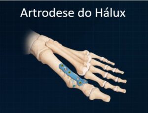 Hálux Valgo (Joanete): o que é, causa, diagnóstico e tratamento