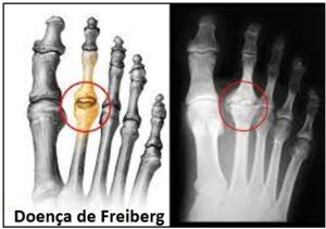 Metatarsalgia: o que é, causa, diagnóstico e tratamento