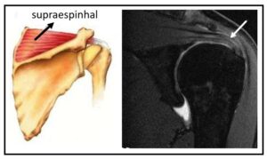 Tendinopatia do Supraespinhal - Medicina de Excelência