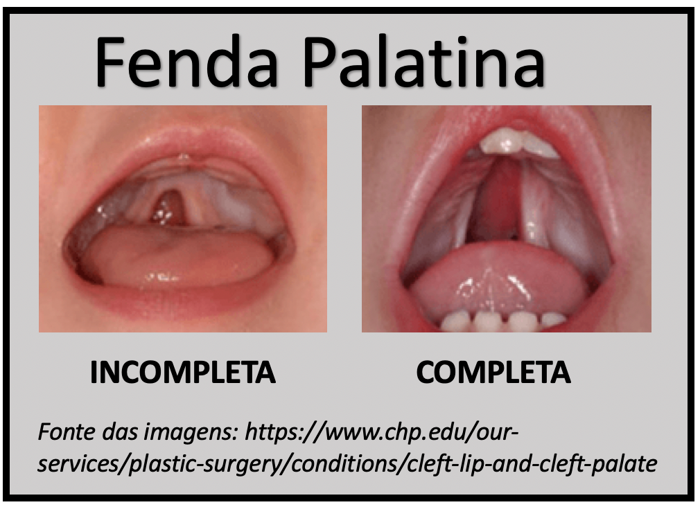 Lábio Leporino - Medicina de Excelência