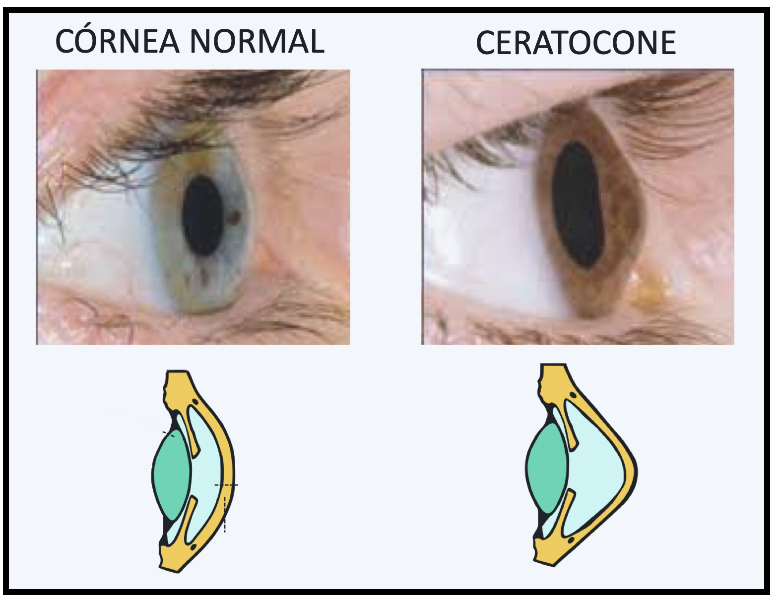 Ceratocone - Medicina de Excelência