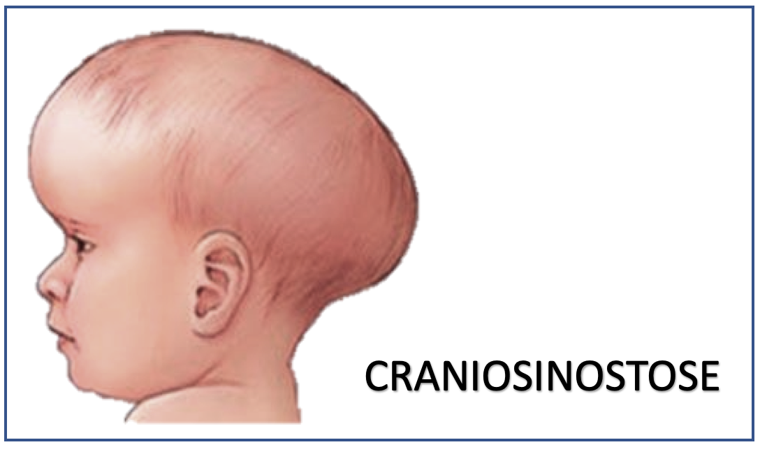 Craniossinostose - Medicina de Excelência