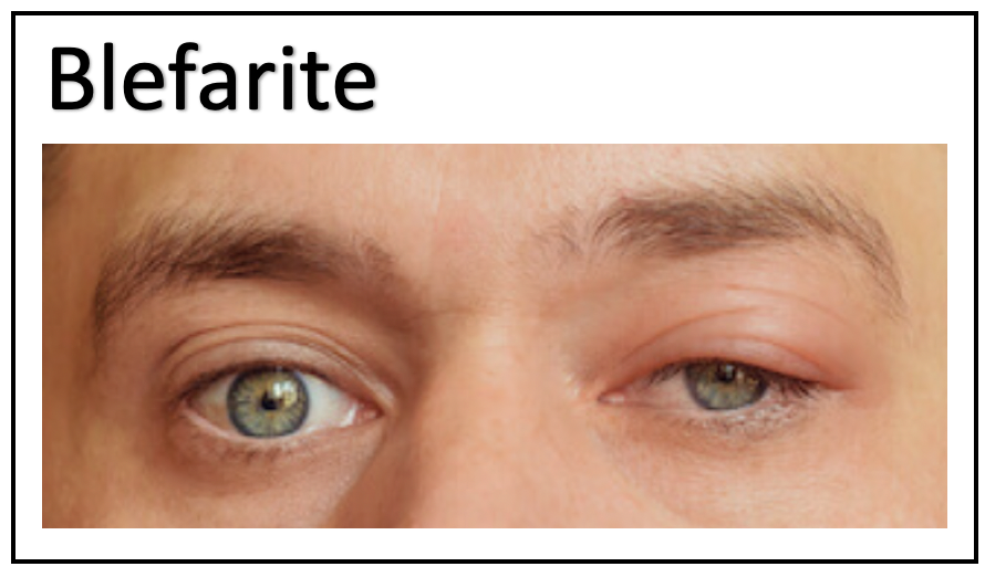 Blefarite - Medicina de Excelência