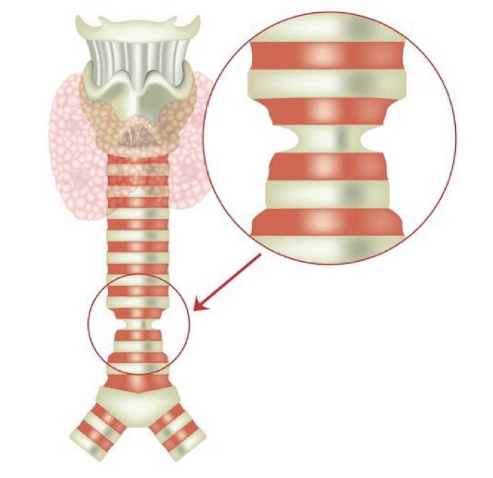 Estenose de traqueia e traqueoplastia - Medicina de Excelência