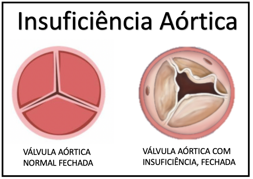 Insuficiência Aórtica (Regurgitação) - Medicina de Excelência