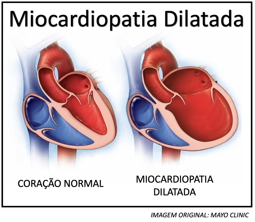 Miocardiopatia Dilatada - Medicina de Excelência