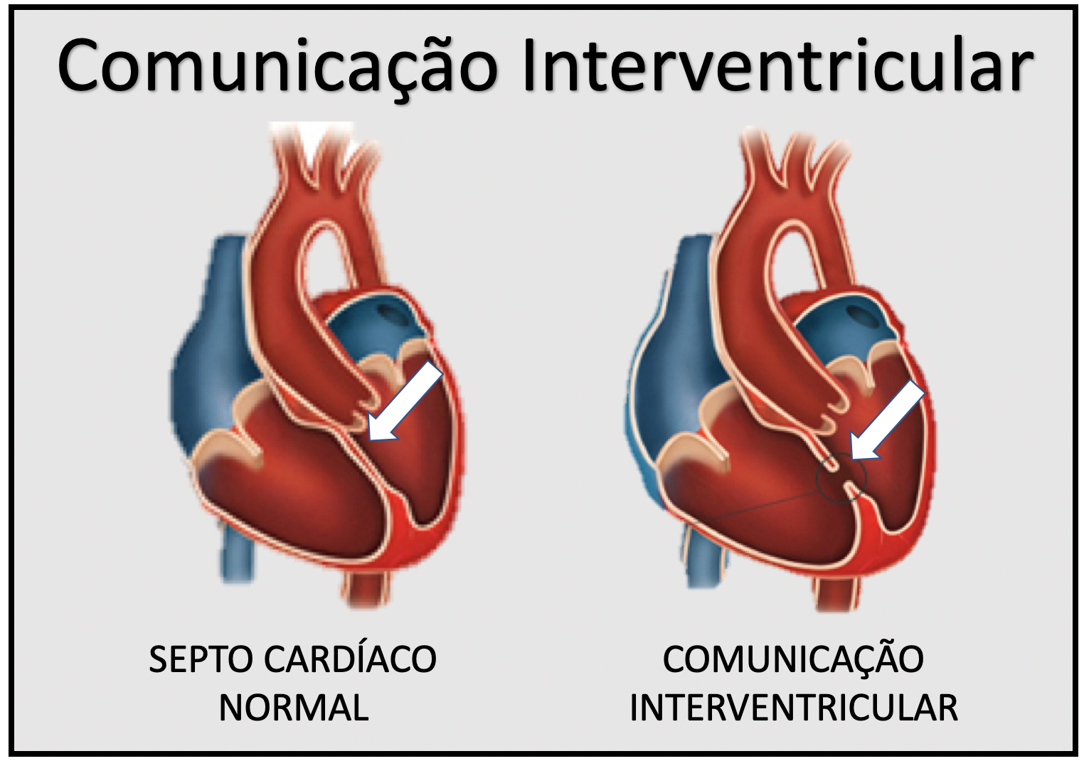 Comunicação Interventricular (CIV) - Medicina de Excelência