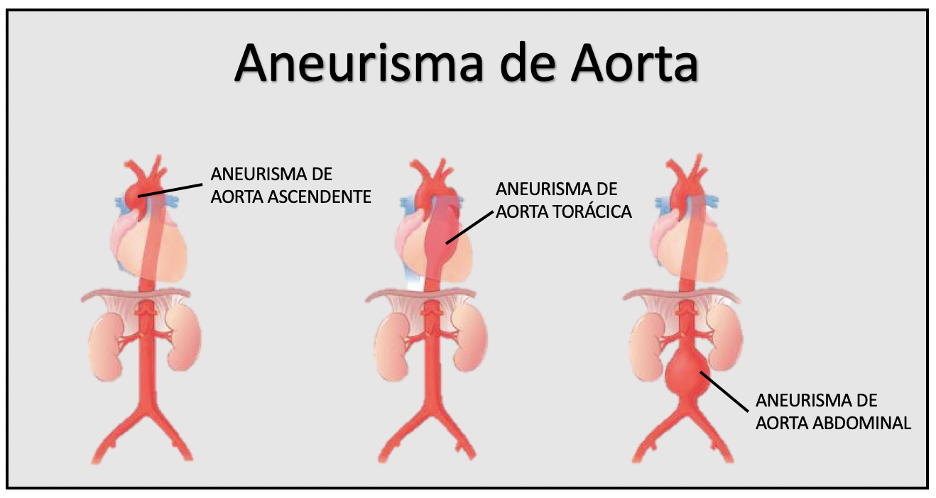 Aneurisma de Aorta - Medicina de Excelência