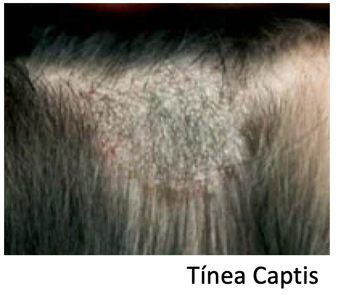 Tínea Captis (micose do couro cabeludo) - Medicina de Excelência