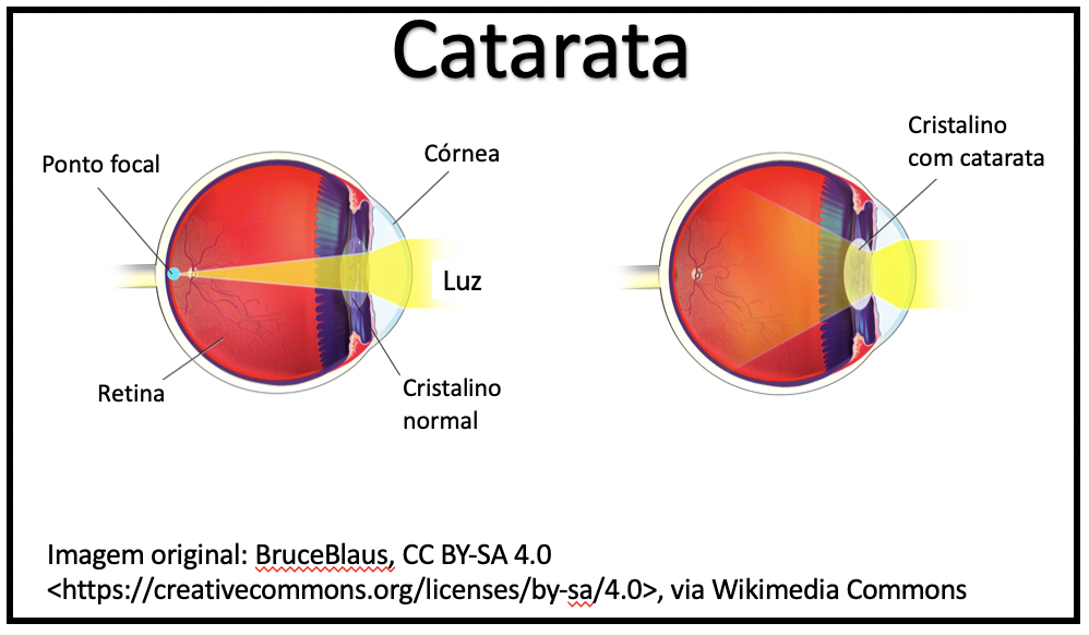 Catarata - Medicina de Excelência