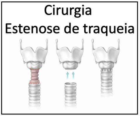 Estenose de traqueia e traqueoplastia - Medicina de Excelência