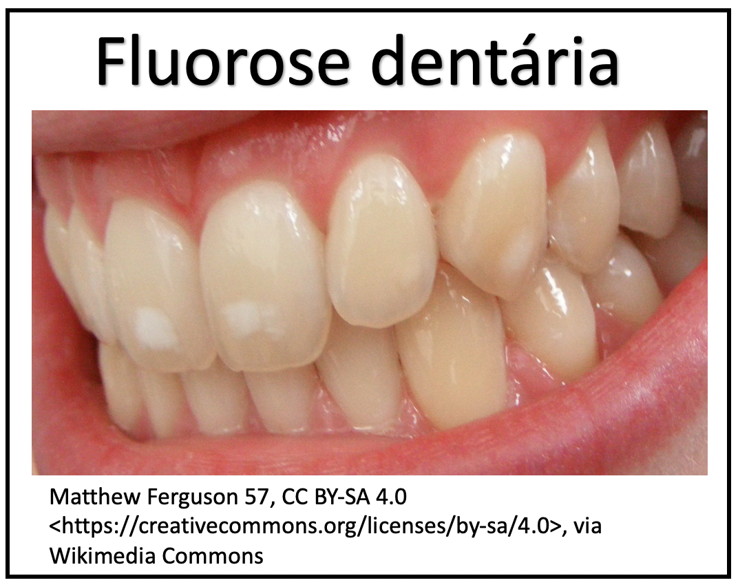 Fluorose Dentária - Medicina de Excelência