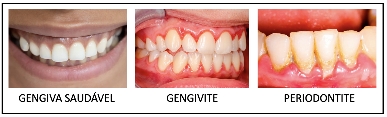 Gengivite - Medicina de Excelência
