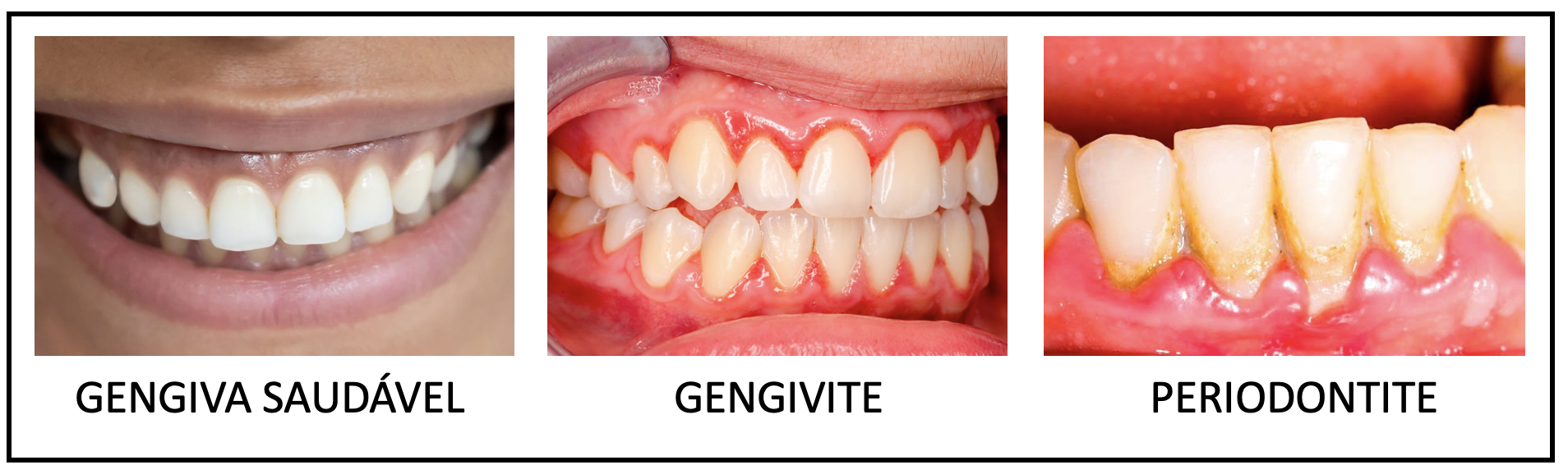Gengivite - Medicina de Excelência