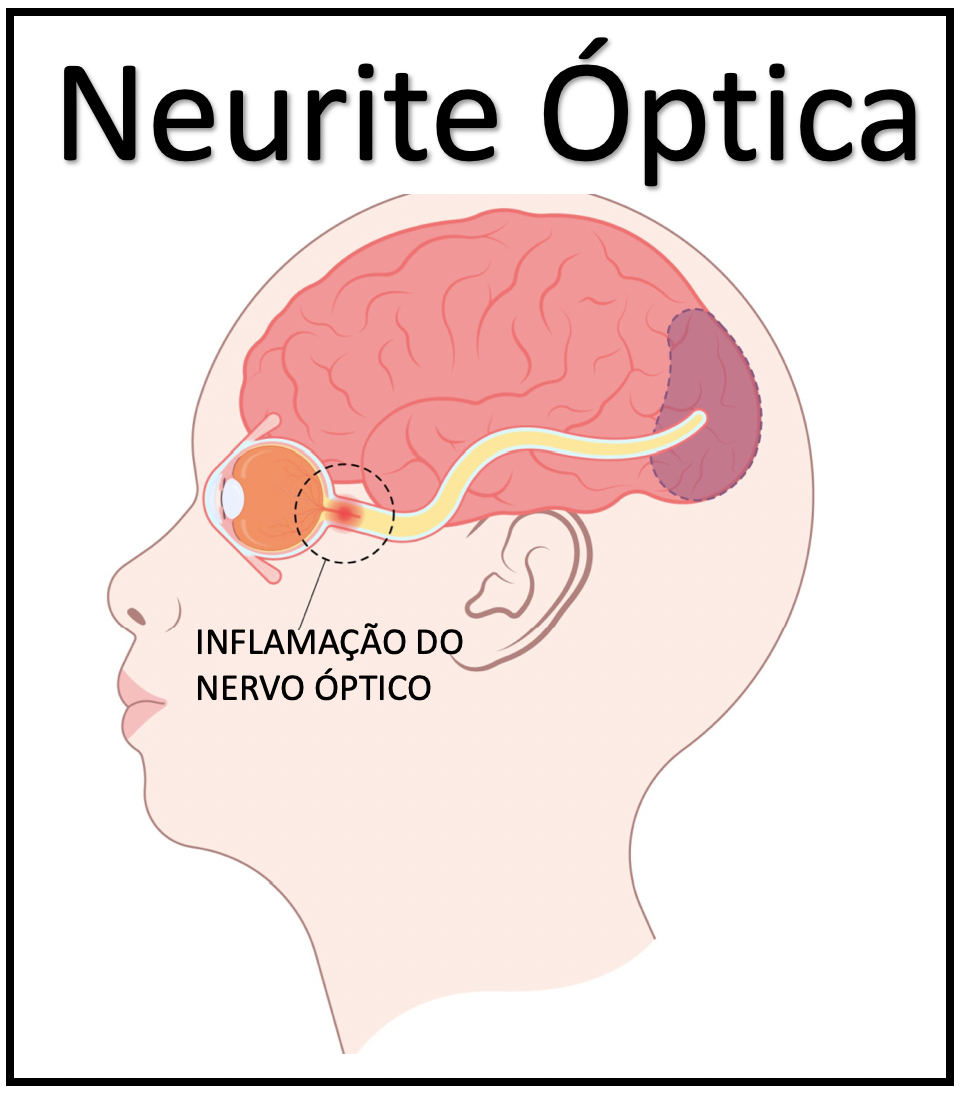 Neurite Óptica - Medicina de Excelência