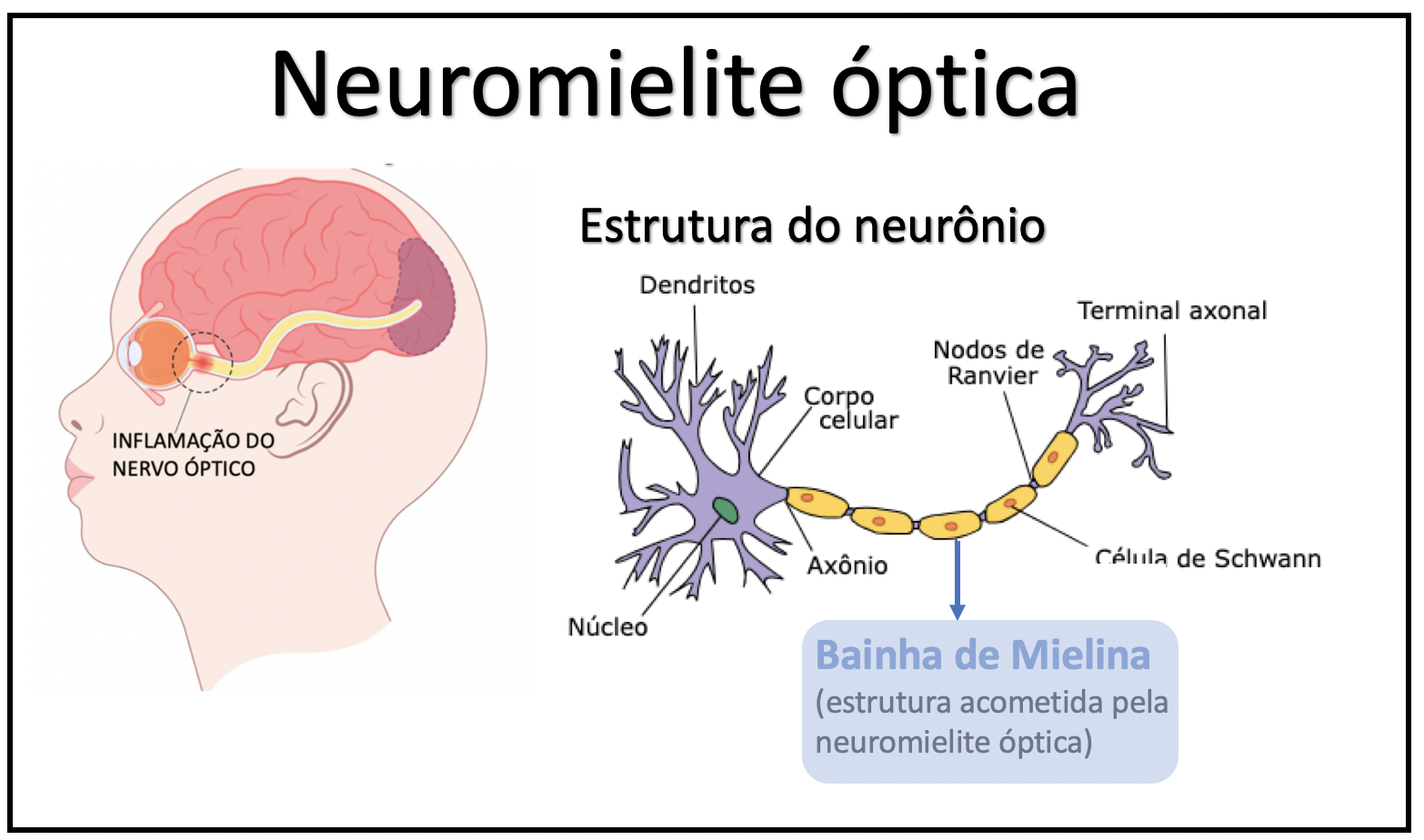 Neuromielite Óptica - Medicina de Excelência