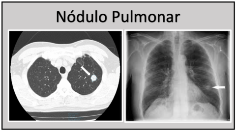 Nódulo Pulmonar - Medicina de Excelência