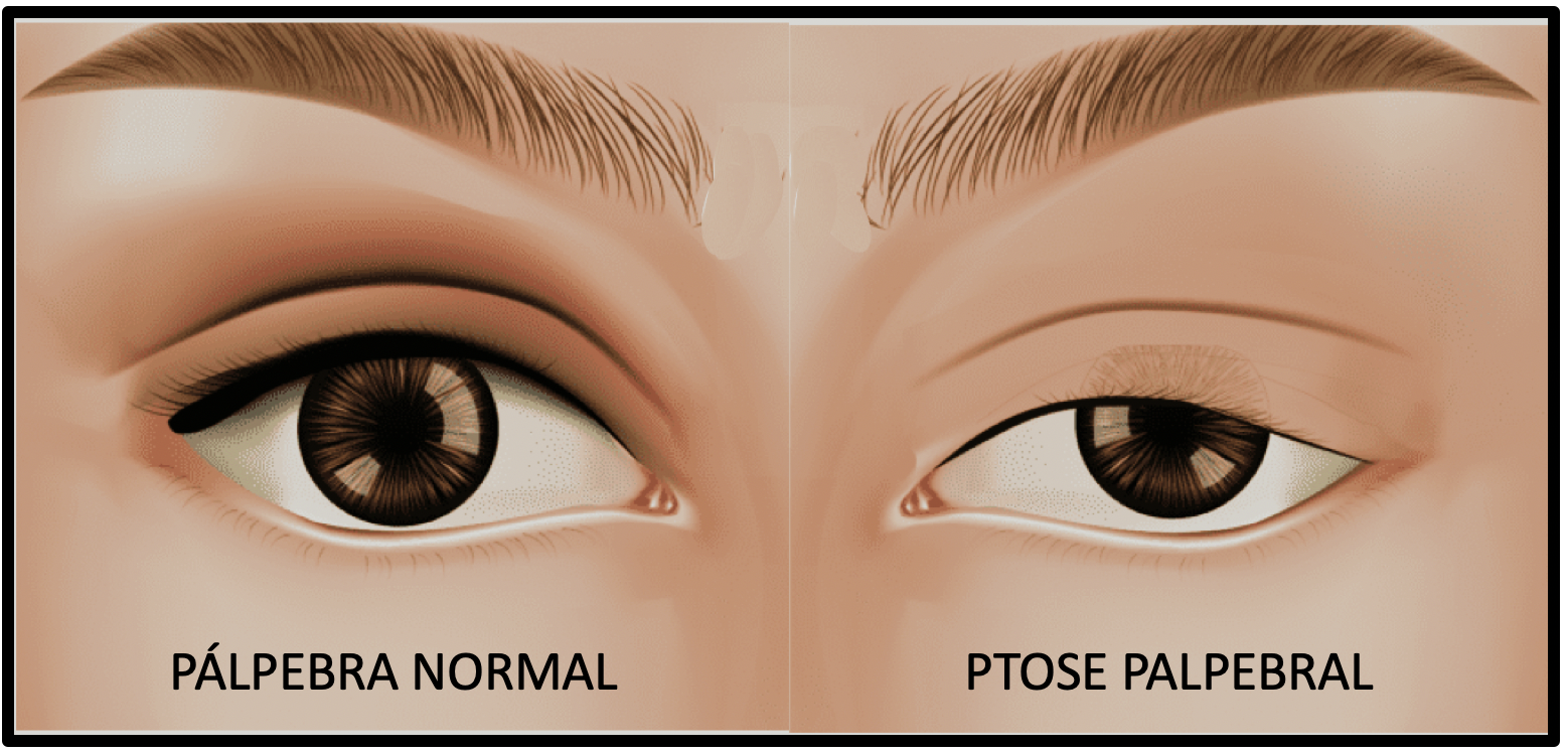 Ptose Palpebral (Pálpebra Caída) - Medicina de Excelência