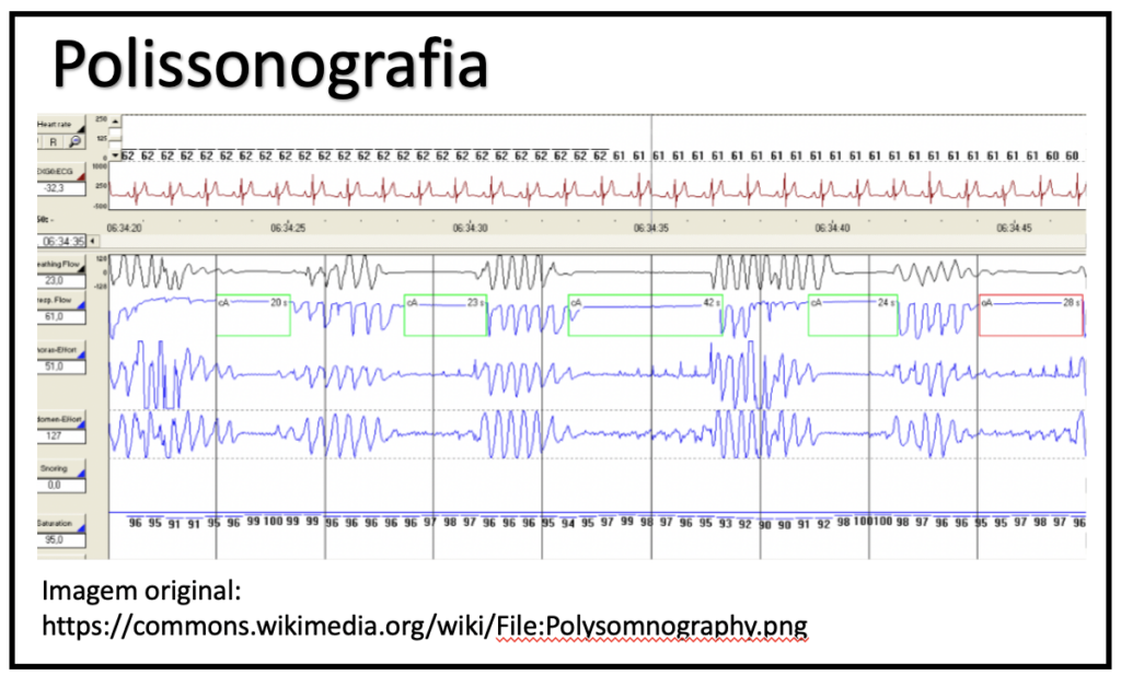 Polissonografia - Medicina de Excelência