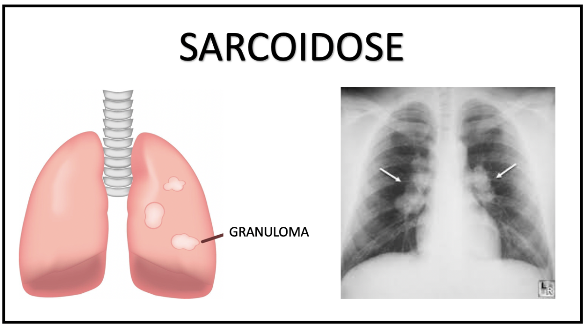 Sarcoidose - Medicina de Excelência