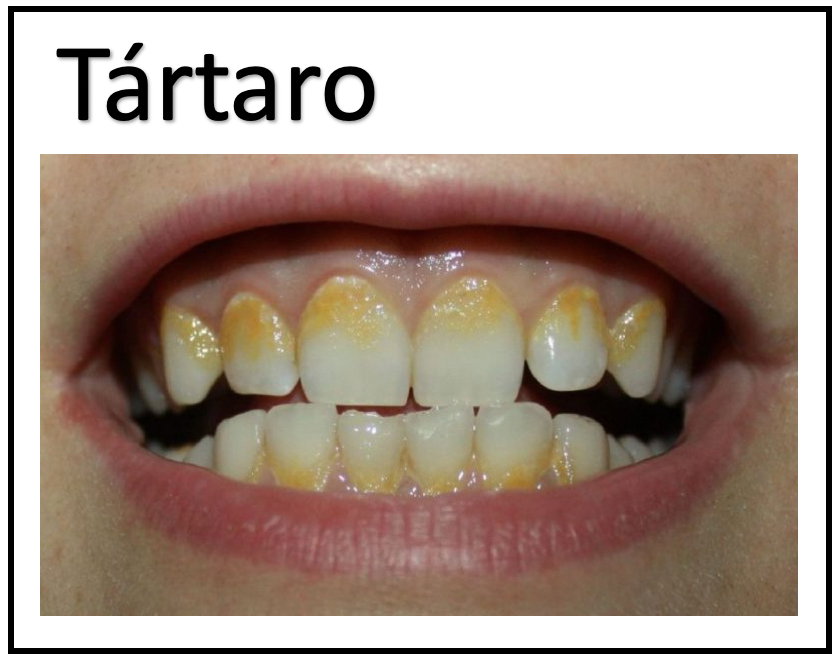 Placa Bacteriana e Tártaro - Medicina de Excelência
