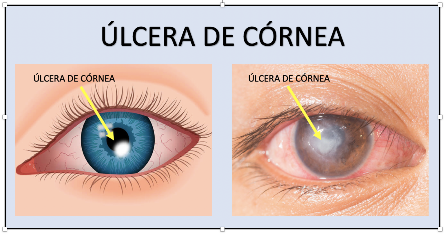 Úlcera de Córnea (Ceratite) - Medicina de Excelência