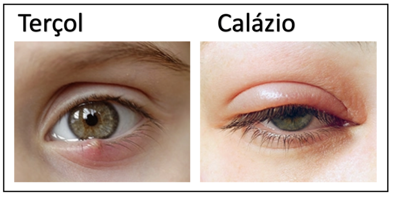 Calázio - Medicina de Excelência