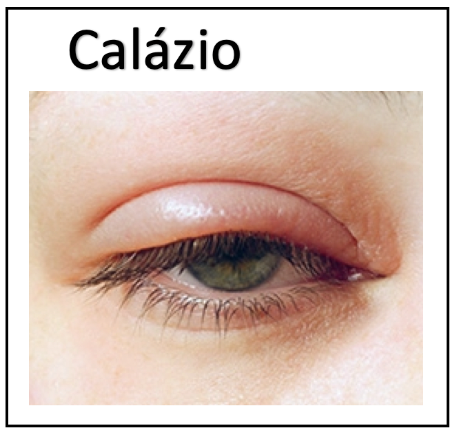 Calázio - Medicina de Excelência