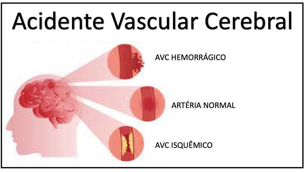 Acidente Vascular Cerebral (AVC): tipos, sintomas,