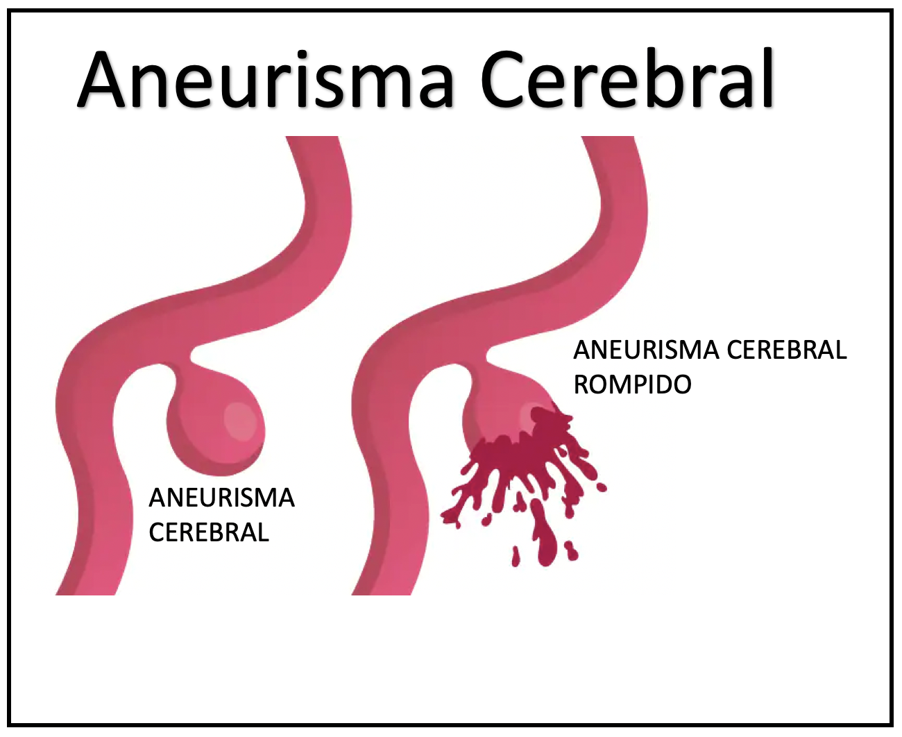 Aneurisma Cerebral - Medicina de Excelência