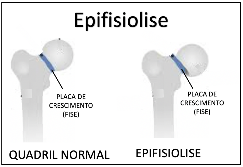 Epifisiolise - Medicina de Excelência