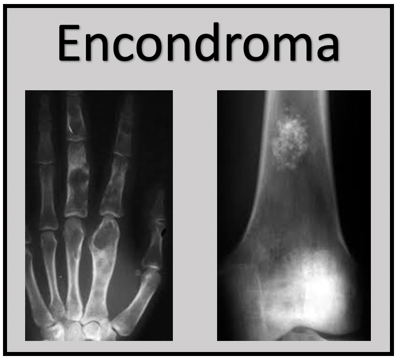 Encondroma - Medicina de Excelência