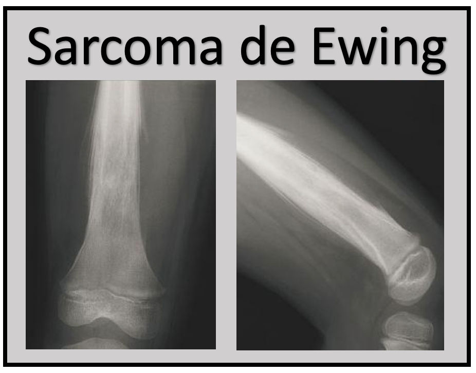 Sarcoma de Ewing - Medicina de Excelência
