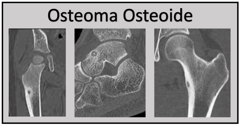 Osteoma Osteoide - Medicina de Excelência