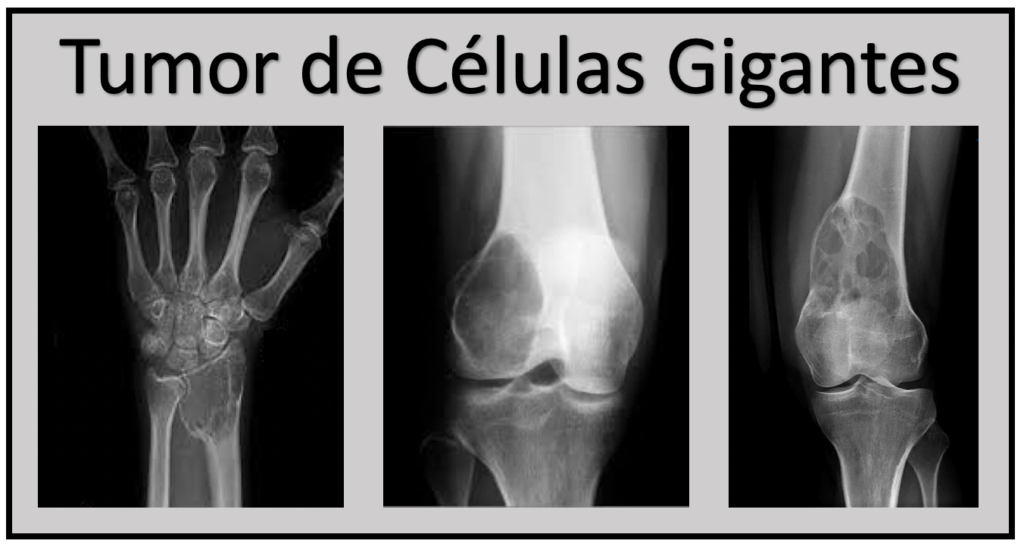 Tumor de células gigantes - Medicina de Excelência