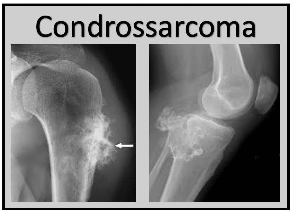 Condrossarcoma - Medicina de Excelência