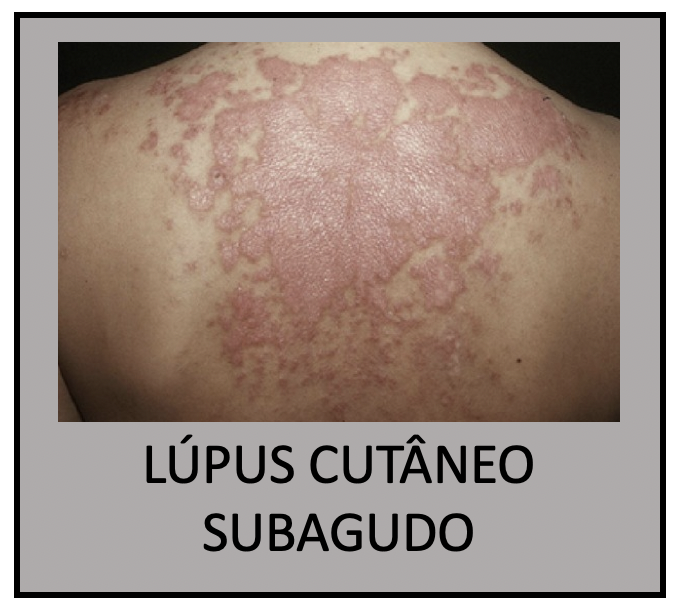 Lúpus Eritematoso Sistêmico | Reumatologia | Medicina de Excelência