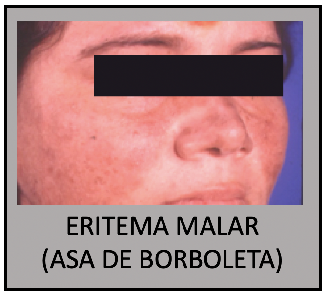 Lúpus Eritematoso Sistêmico | Reumatologia | Medicina de Excelência