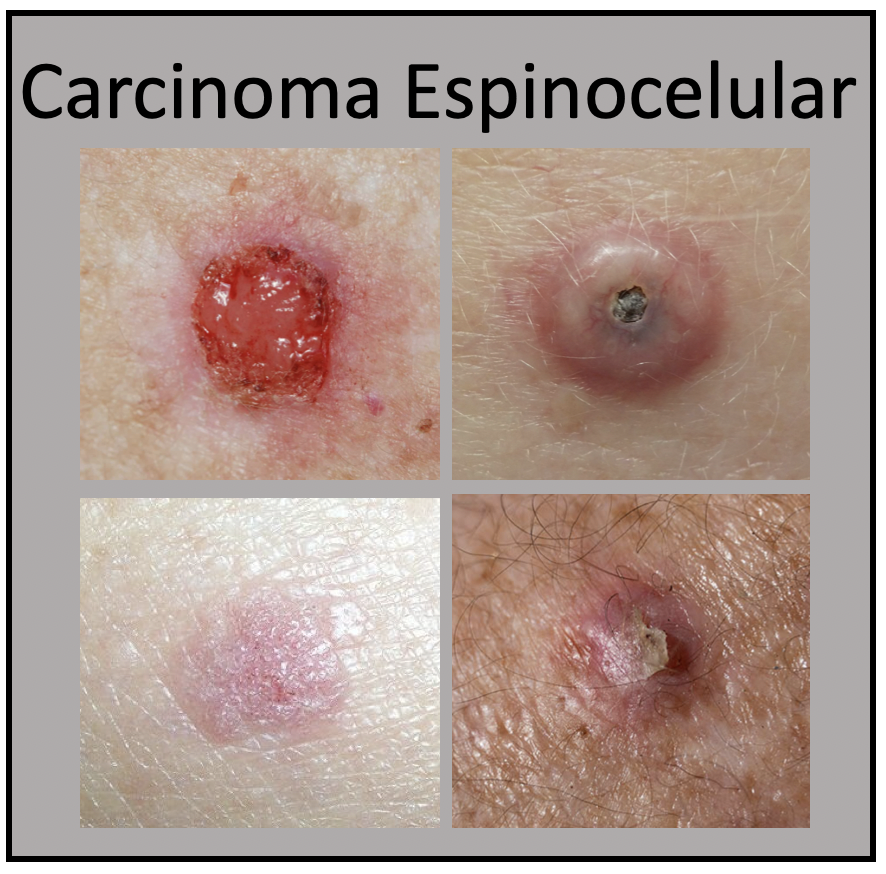 Carcinoma espinocelular - Medicina de Excelência